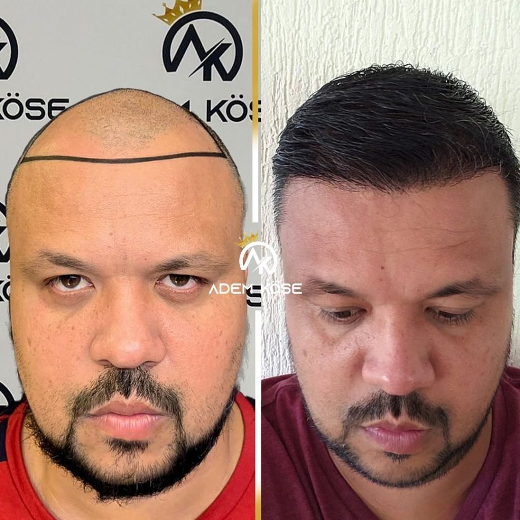 Adem Köse – Hair Transplant Price 2023
