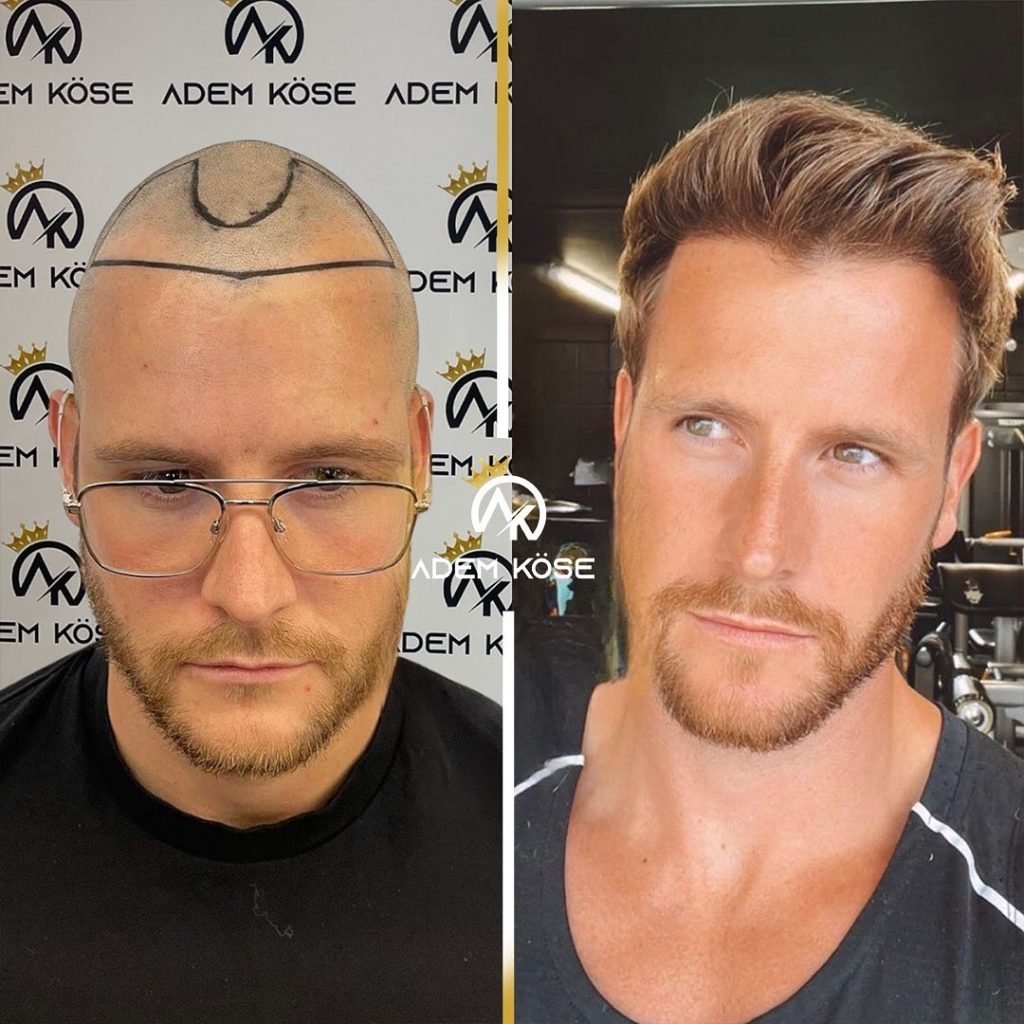 Adem Köse – Hair Transplant Price 2023