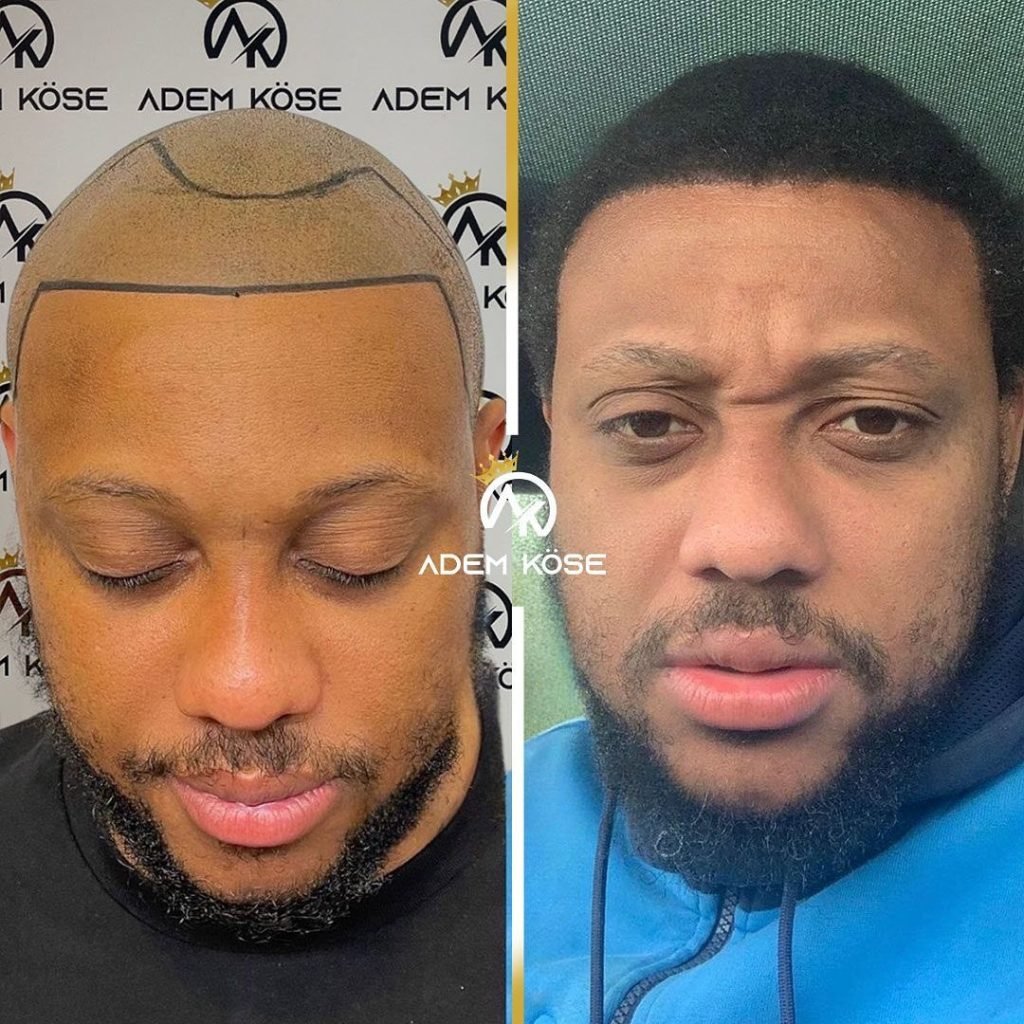 Adem Köse – Hair Transplant Price 2023